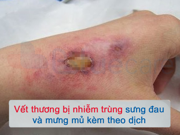 5 dấu hiệu nhiễm trùng vết thương tại nhà & 4 bước xử trí - Bluecare Blog